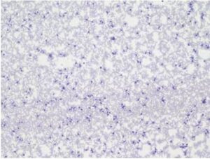 Diagnostisches Vorgehen bei Leukozytosen